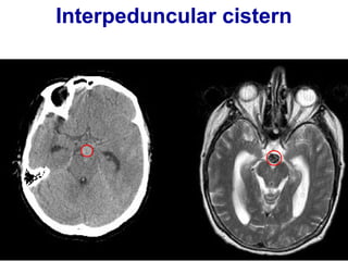 Basal Cisterns Anatomy