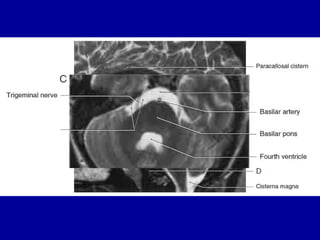 Basal Cisterns Anatomy