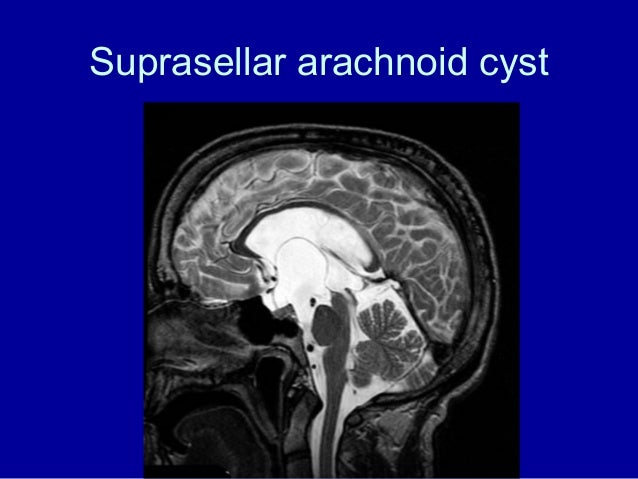 Quadrigeminal Cistern Cyst