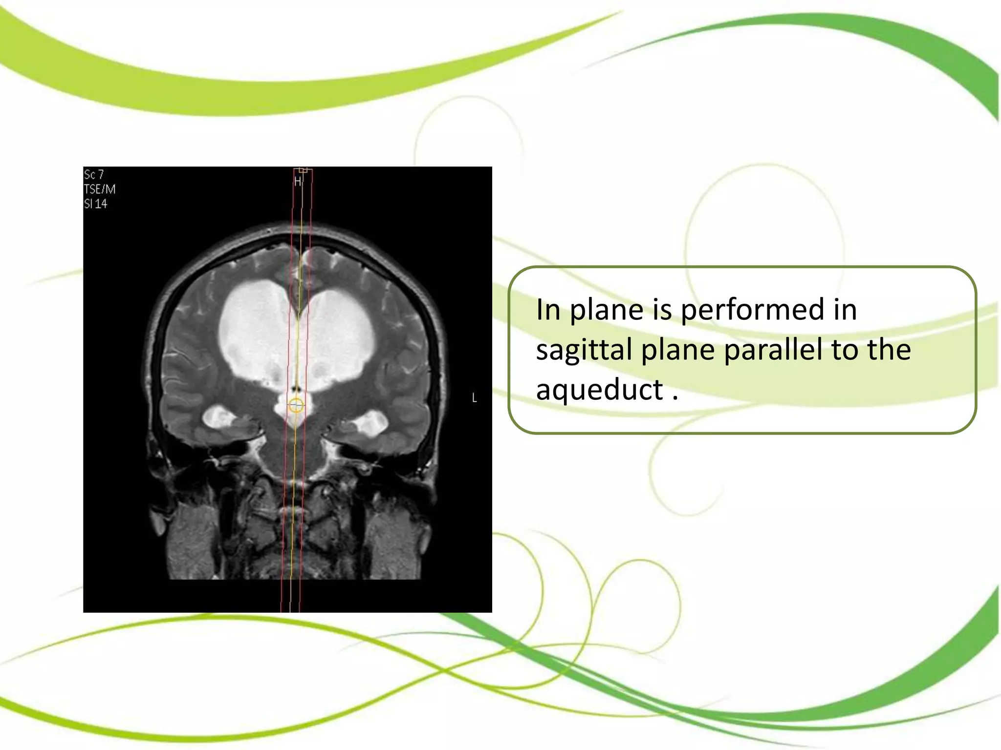 Csf flow study | PPTX