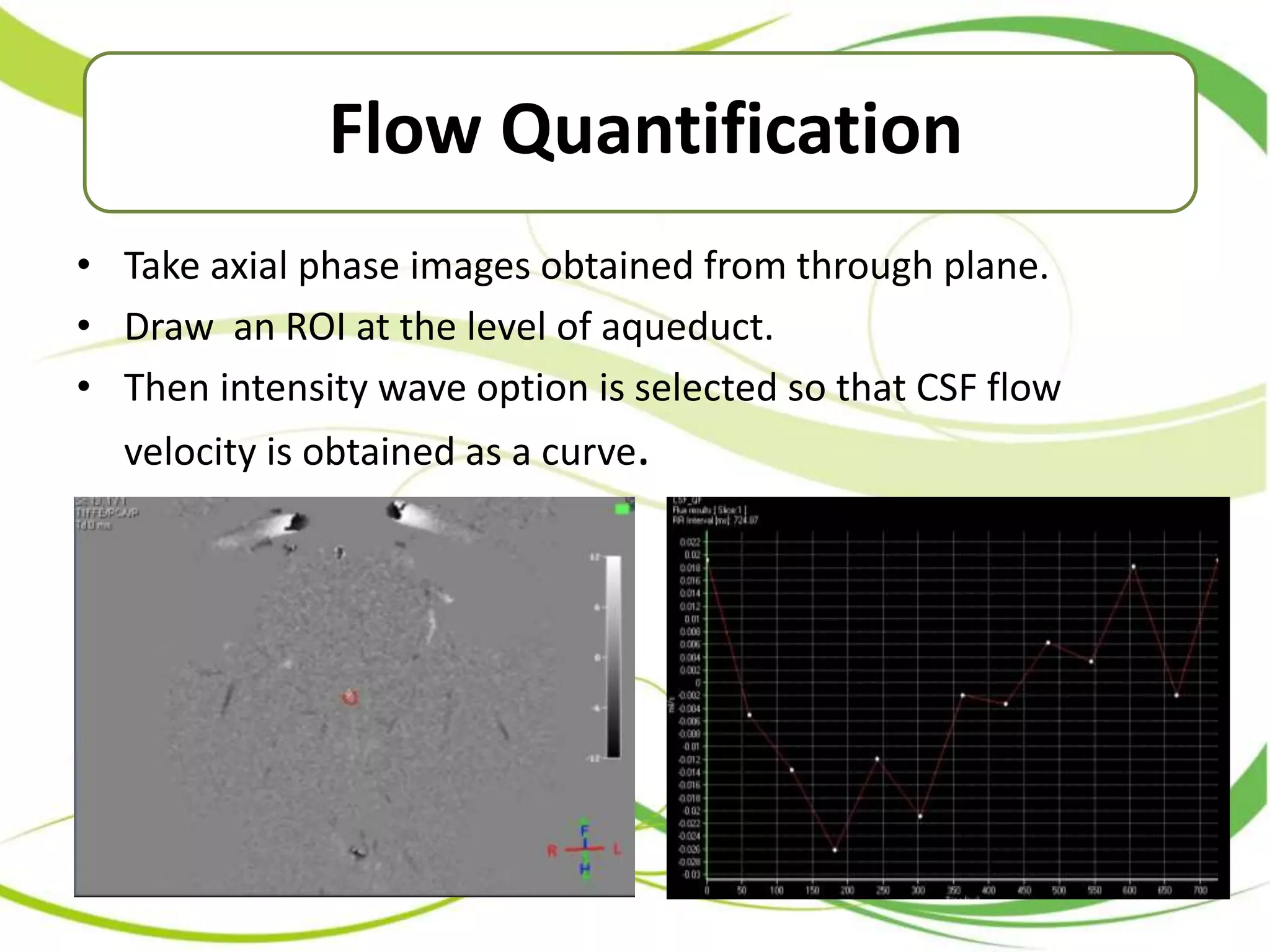 Csf flow study | PPTX