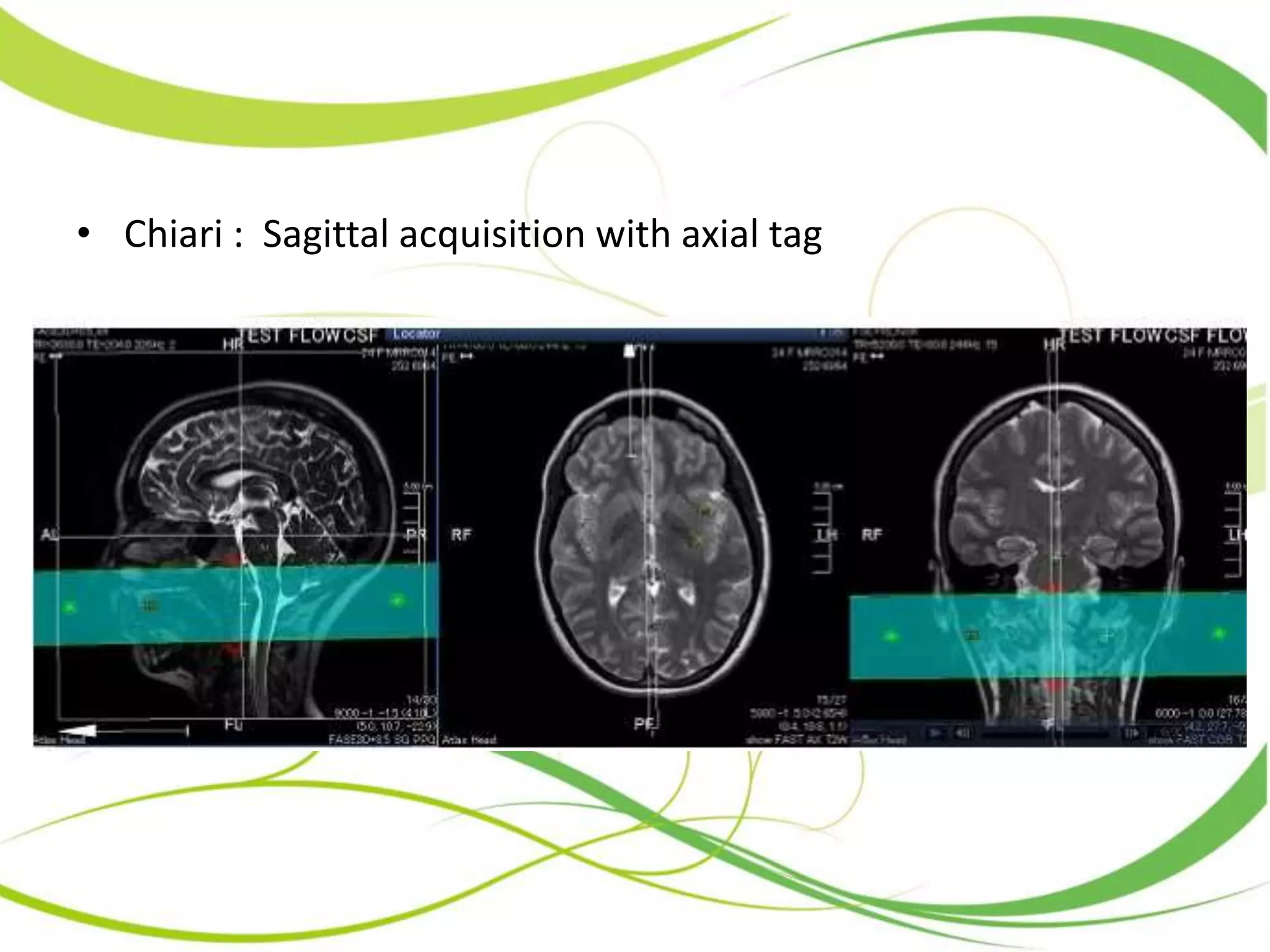Csf flow study | PPTX