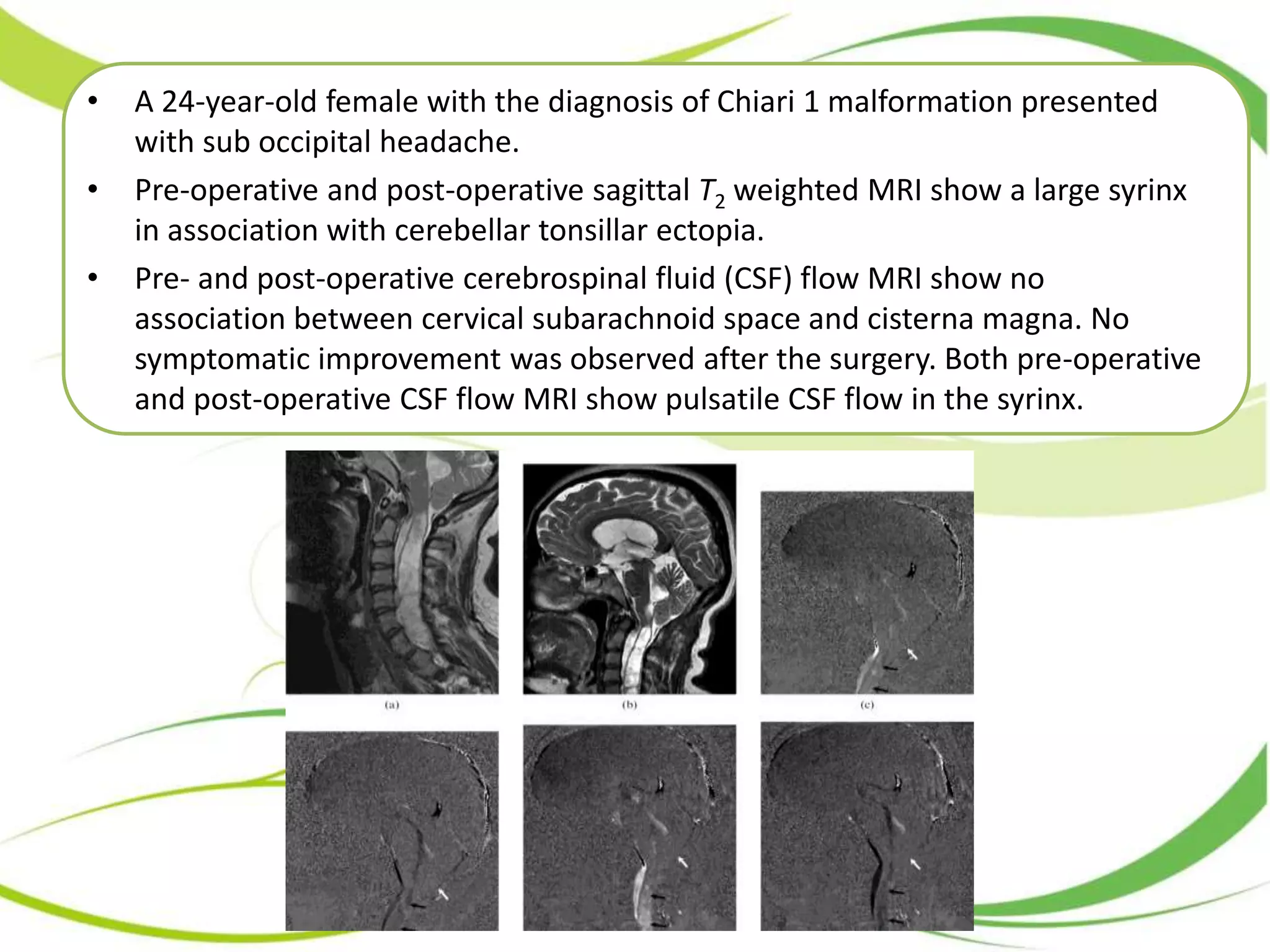 Csf flow study | PPTX