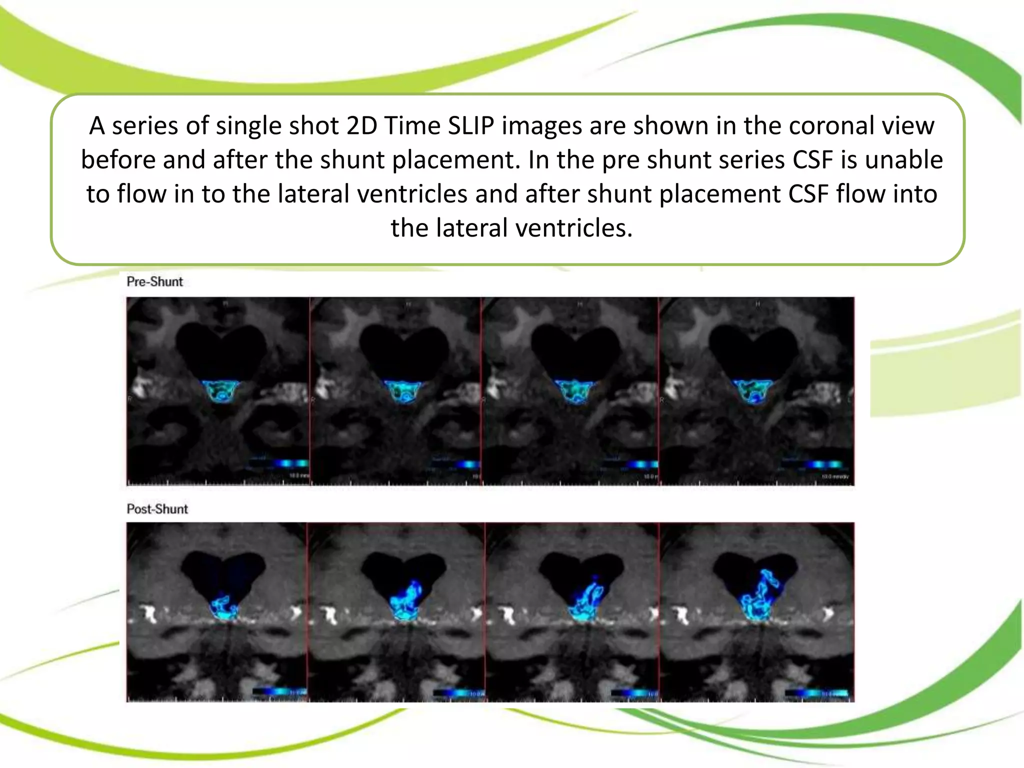 Csf flow study | PPTX