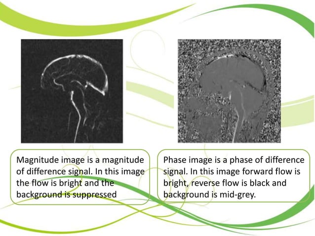 Csf flow study | PPTX