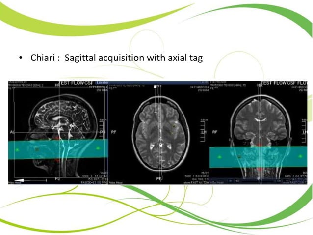 Csf flow study | PPTX