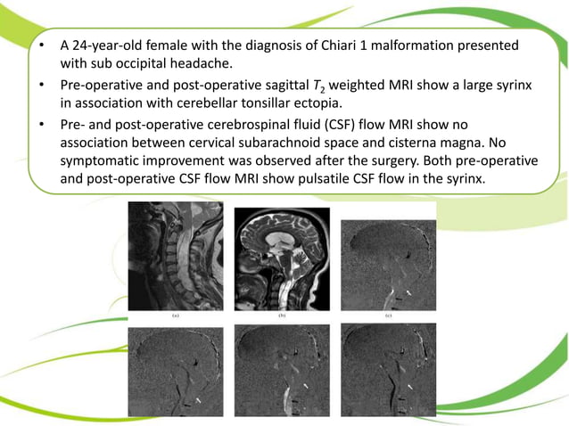 Csf flow study | PPTX