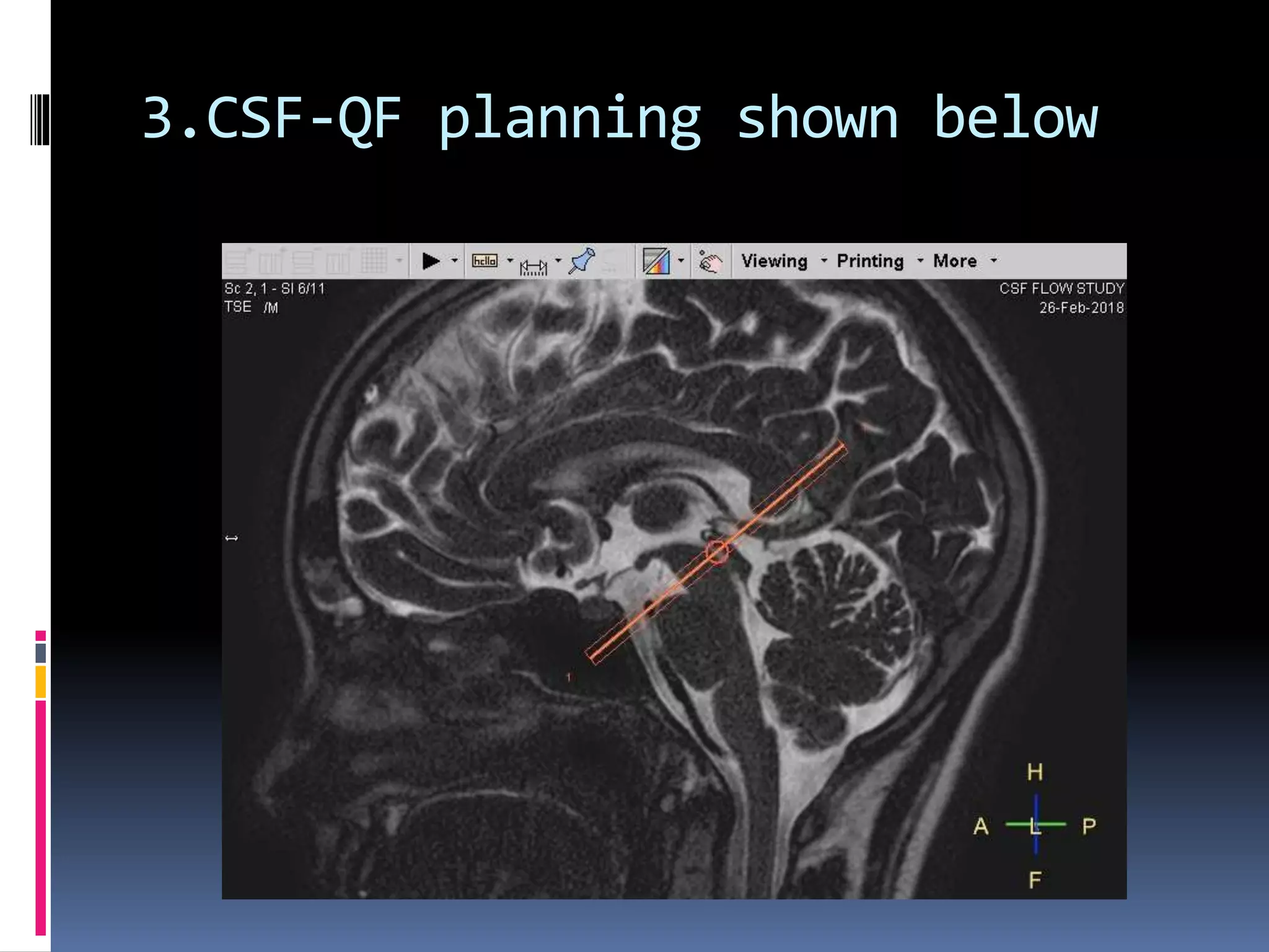 CSF flow study | PPTX