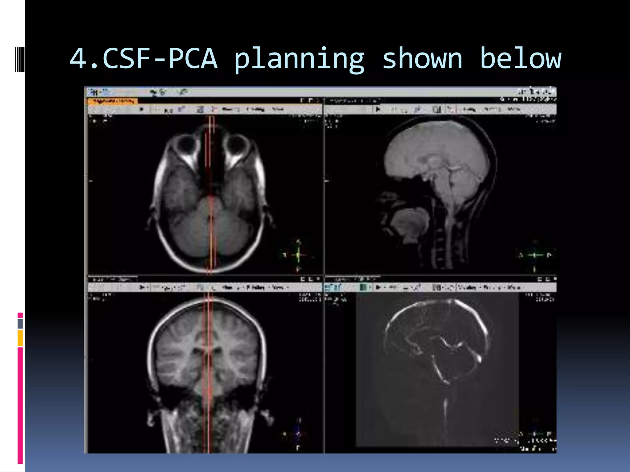 CSF flow study | PPTX