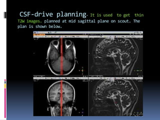 CSF flow study | PPTX