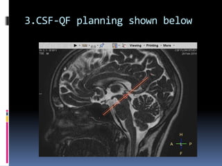 CSF flow study | PPT