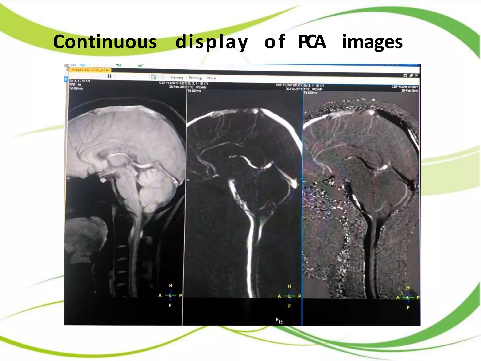 CSF Flow Study In MRI | PPTX