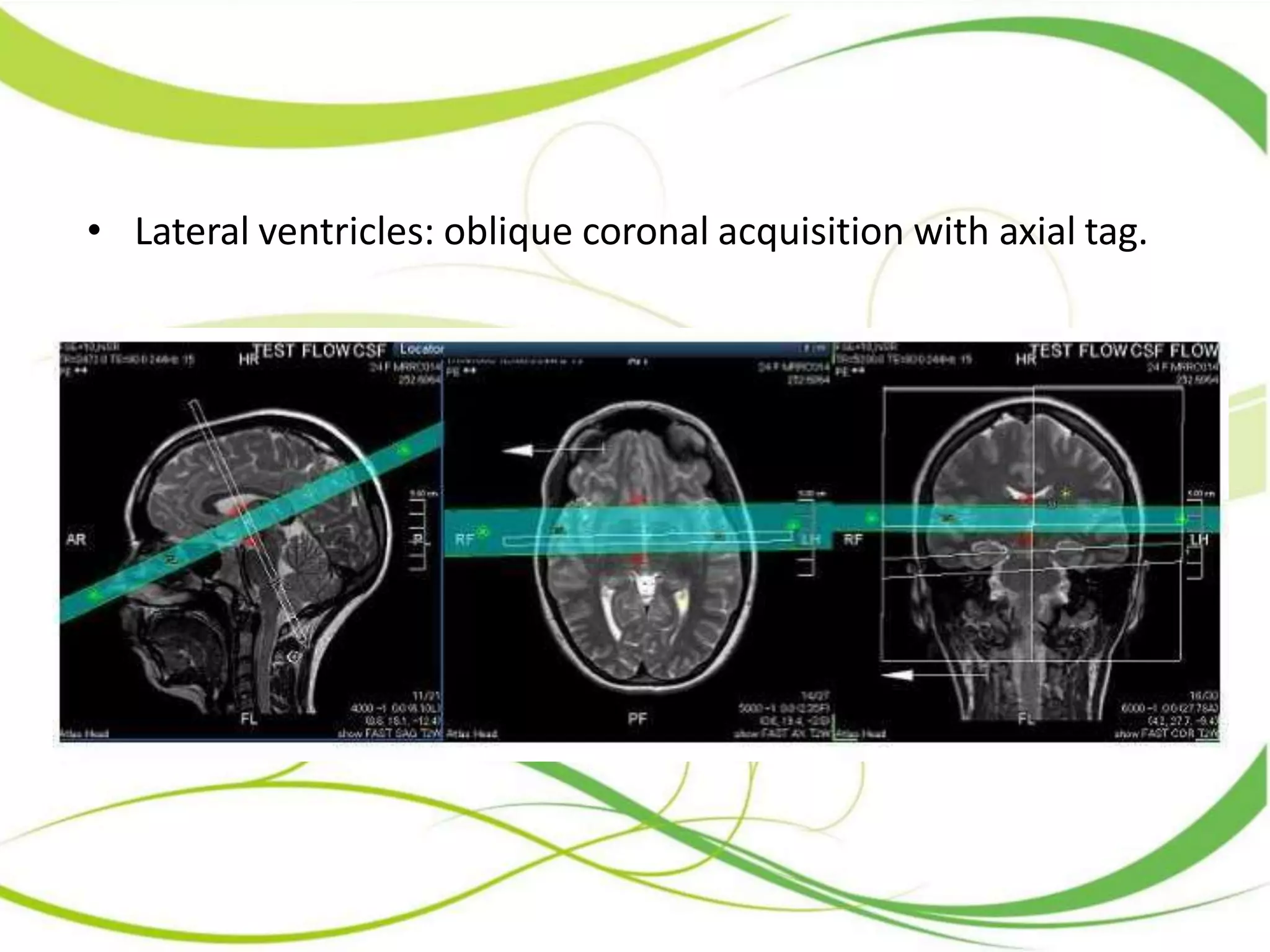 CSF Flow Study In MRI | PPTX