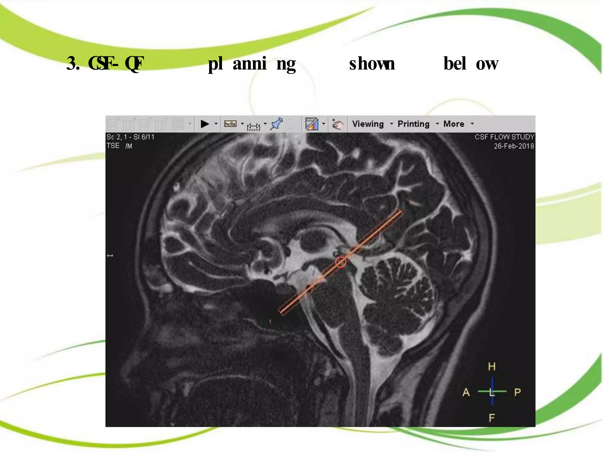 CSF Flow Study In MRI | PPTX
