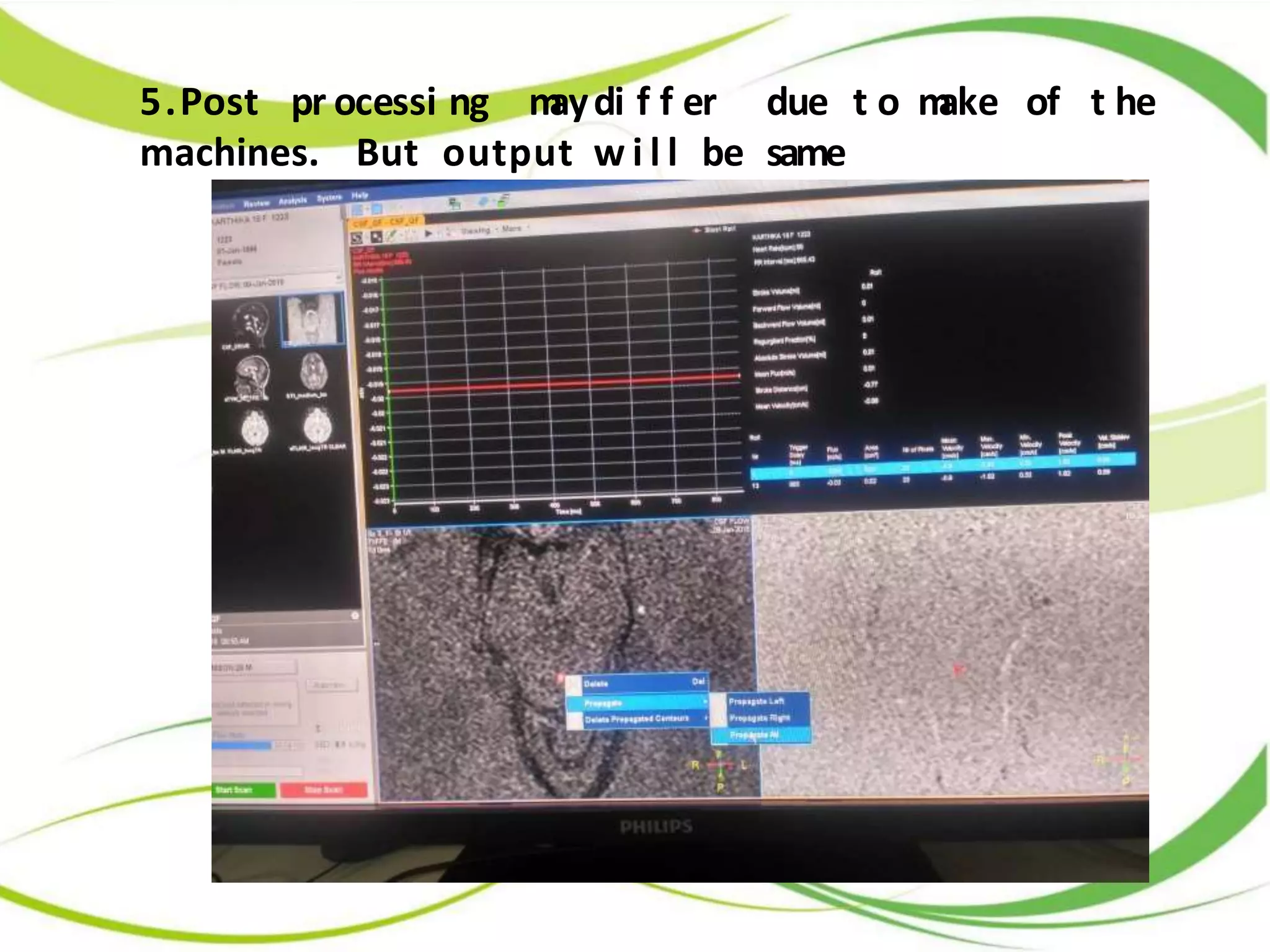 CSF Flow Study In MRI | PPTX