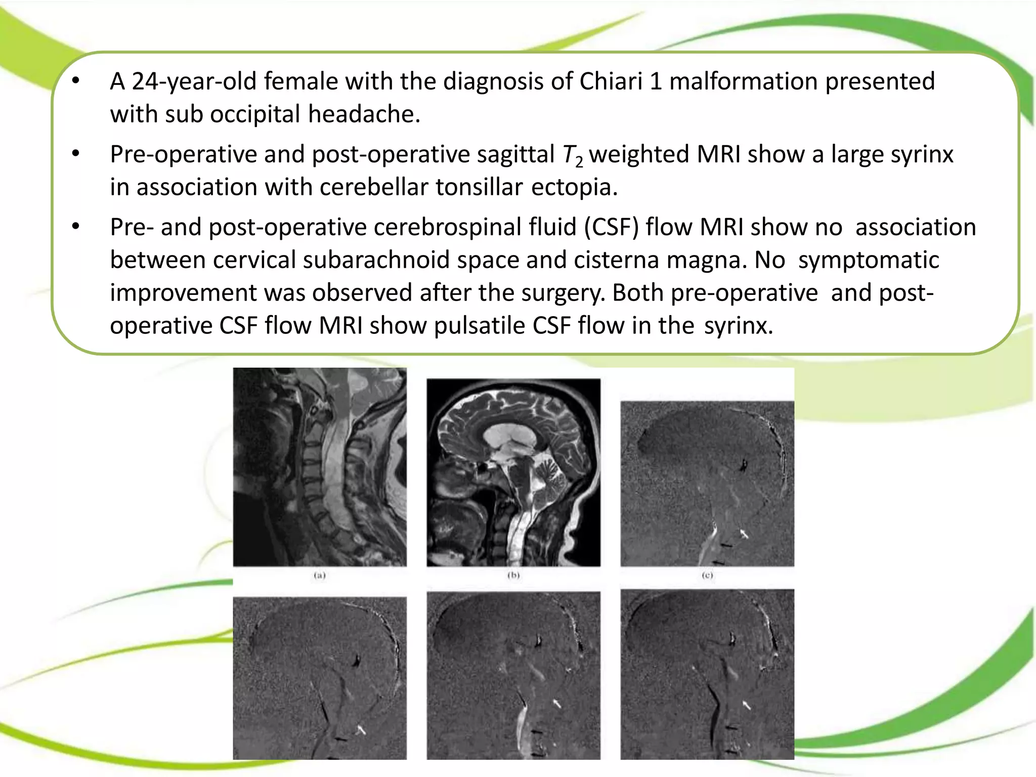 CSF Flow Study In MRI | PPTX