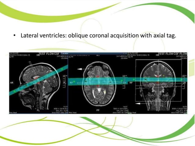 CSF Flow Study In MRI