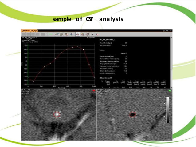 CSF Flow Study In MRI