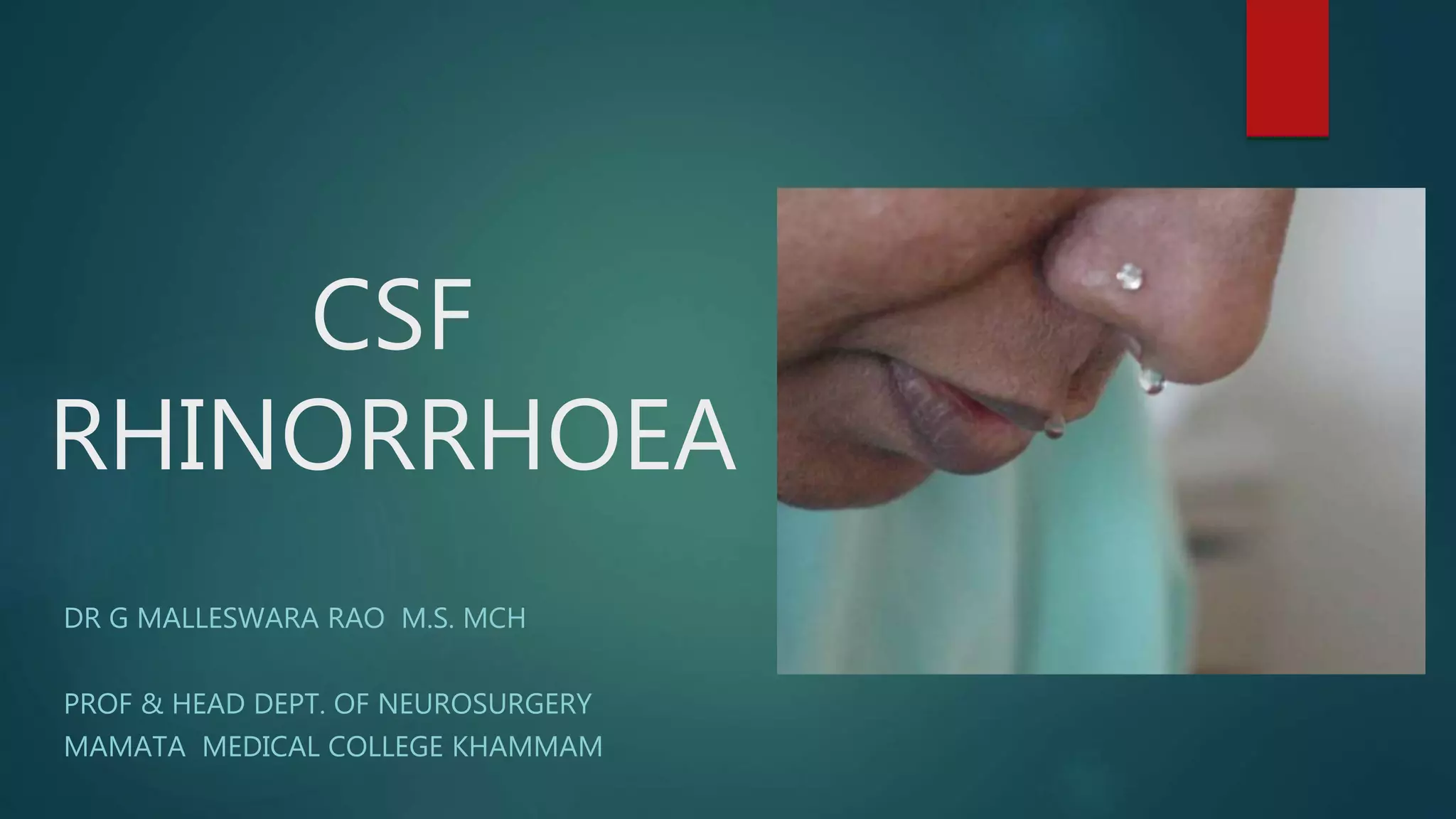 Csf Rhinorrhea - Overview | PPTX