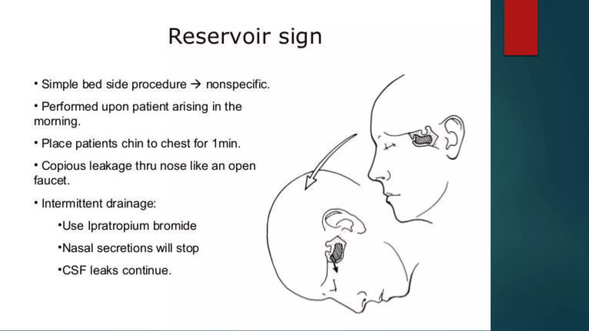 Csf Rhinorrhea - Overview | PPTX