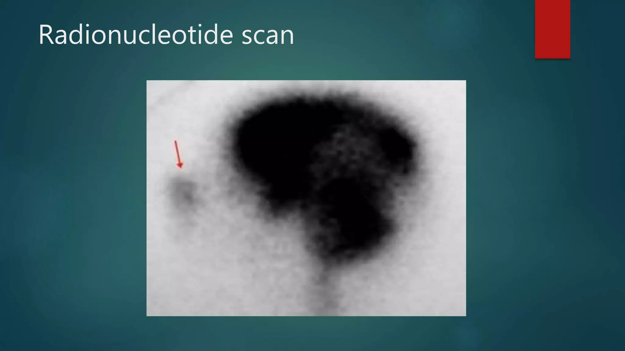 Csf Rhinorrhea - Overview | PPTX