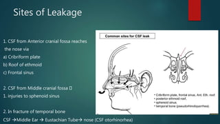 Csf Rhinorrhea - Overview | PPTX