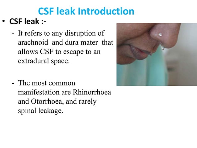 Csf leak and antibiotic. | PPT