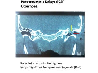 Csf otorrhoea | PPTX