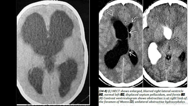 Csf pathway and hydrocephalus | PPTX | Brain and Nervous System ...
