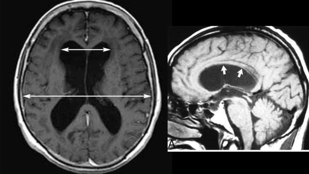 Csf pathway and hydrocephalus | PPTX | Brain and Nervous System ...