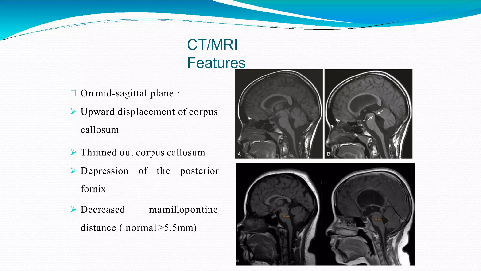 CSF Production, Dynamics and Physiology | PPTX
