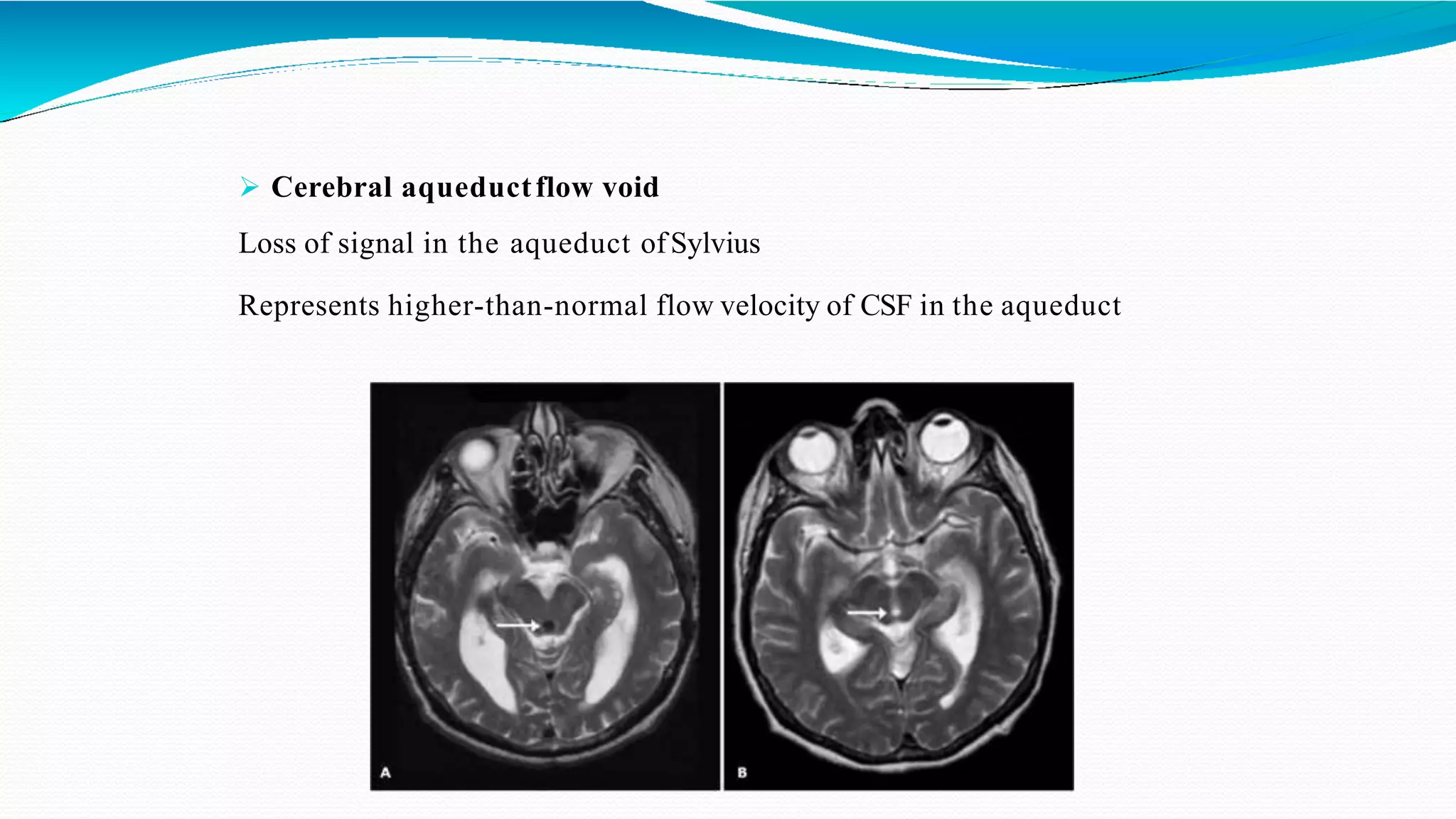 CSF Production, Dynamics and Physiology | PPTX