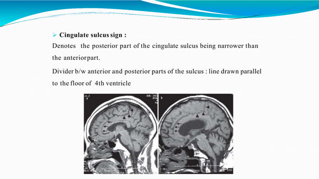 CSF Production, Dynamics and Physiology | PPTX