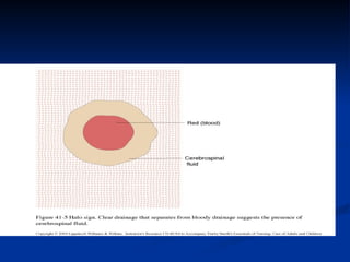 Cerebro spinal fluid rhinorrhea management | PPTX | Ear, Nose and ...