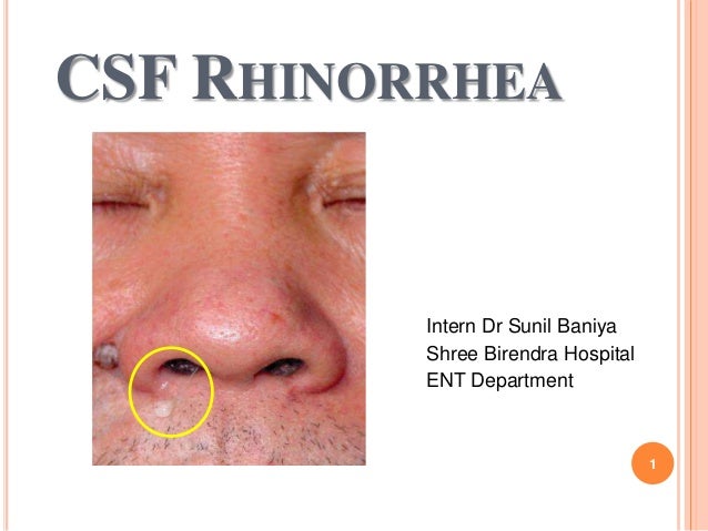 O Rhinorrhea Rhinorrhea