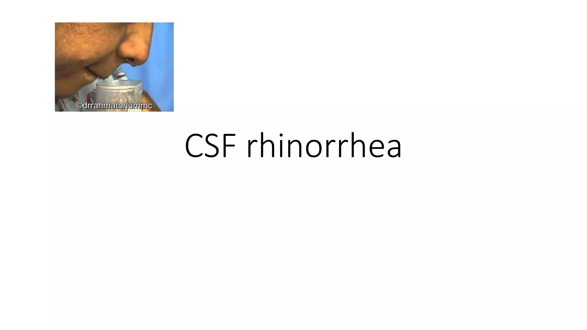 Csf rhinorrhea ppt | PPTX