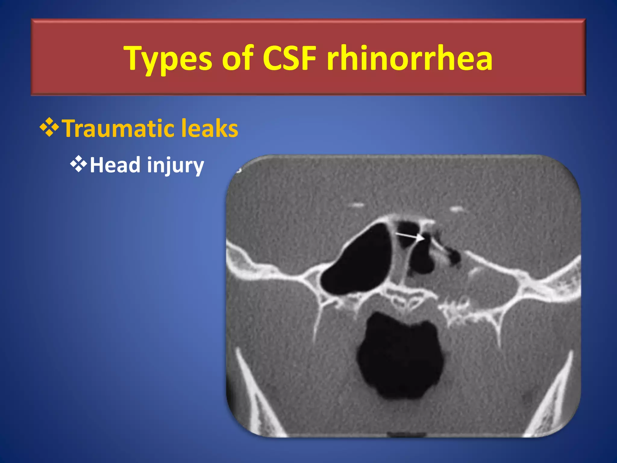 Csf rhinorrhea repair- case report and discussion | PPTX