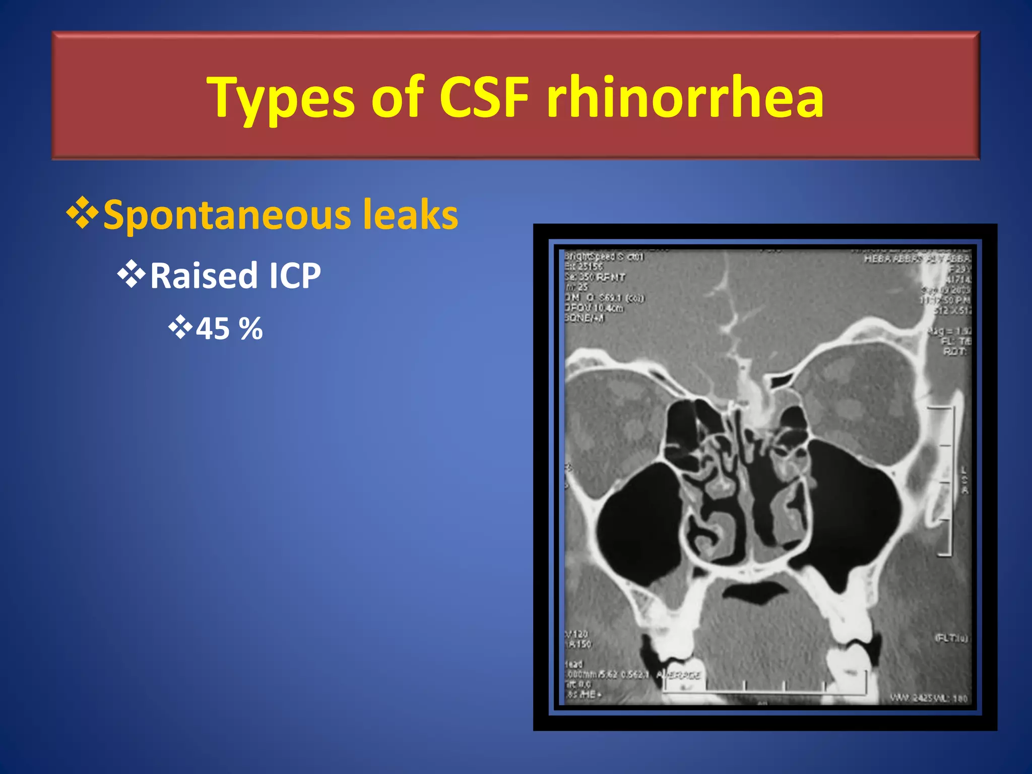 Csf rhinorrhea repair- case report and discussion | PPTX