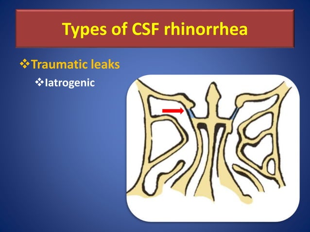 Csf rhinorrhea repair- case report and discussion | PPT
