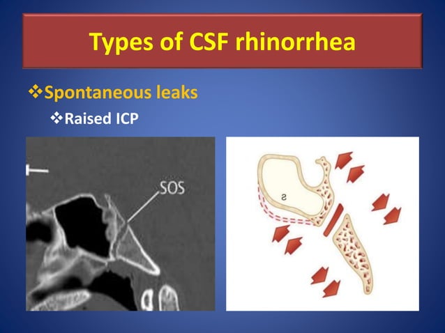 Csf rhinorrhea repair- case report and discussion | PPT