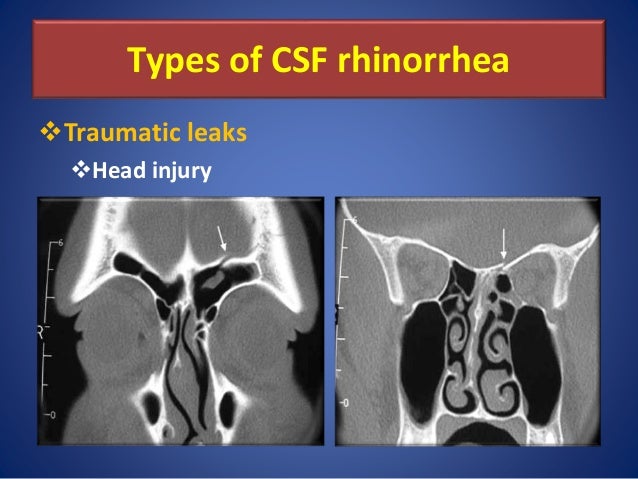 Csf rhinorrhea repair- case report and discussion