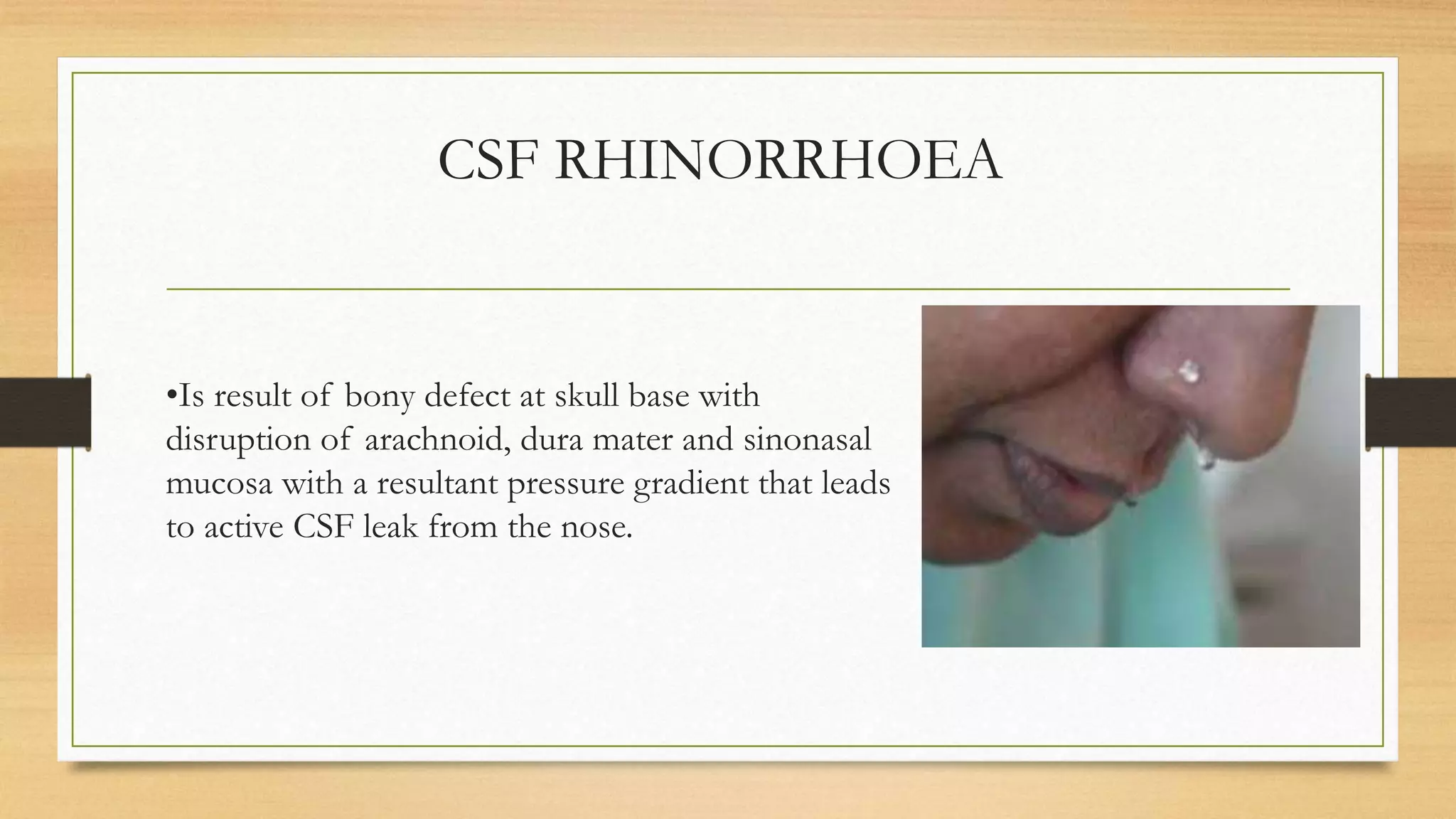 Csf rhinorrhea | PPTX