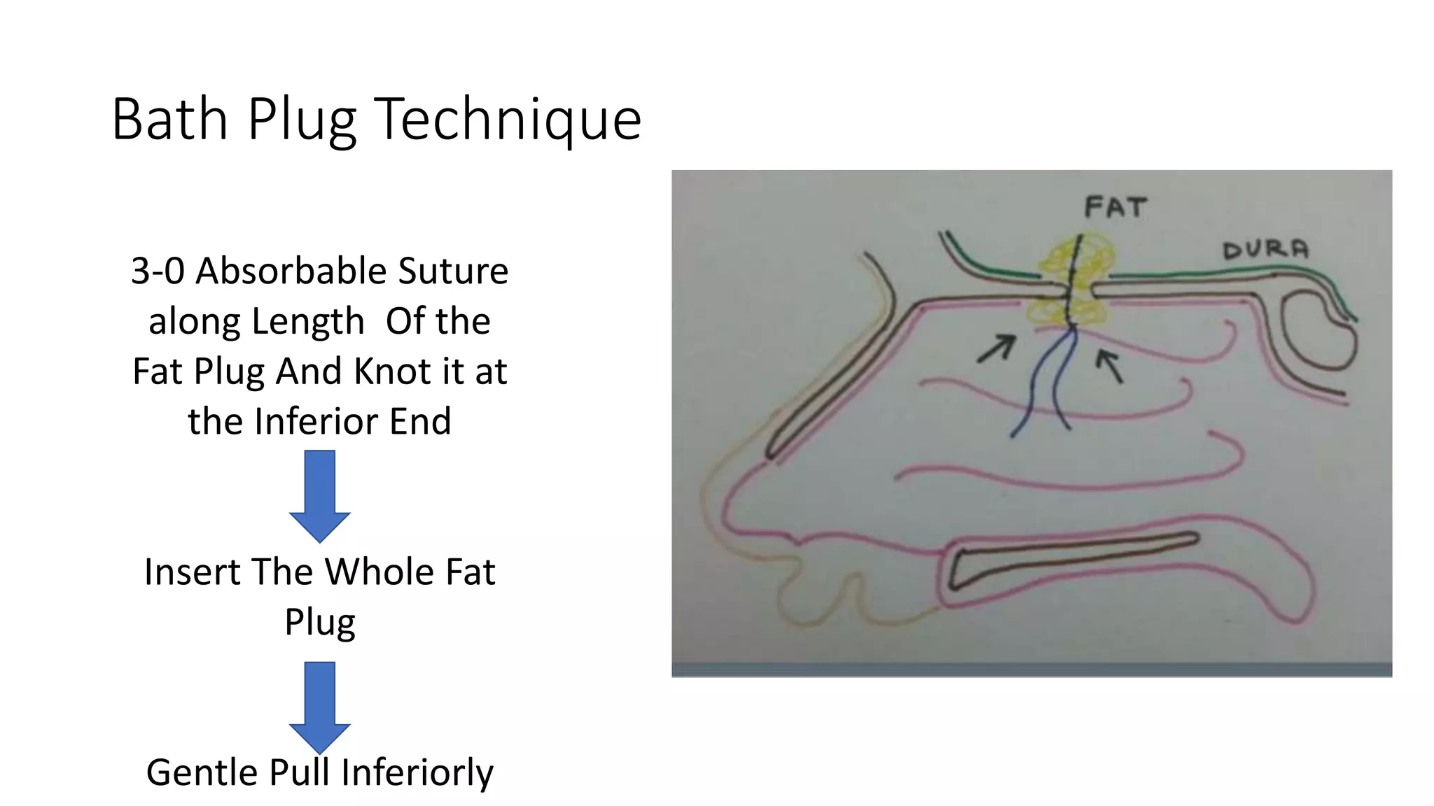 CSF Rhinorrhea | PPTX