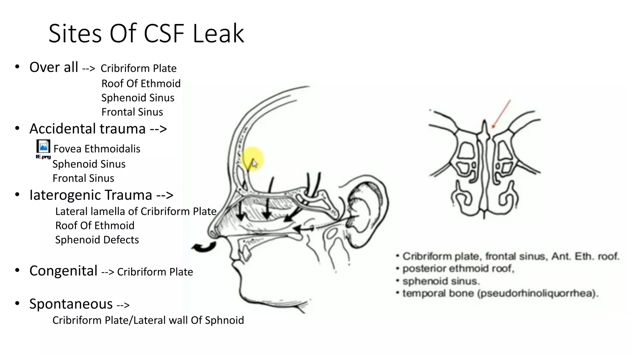 CSF Rhinorrhea | PPTX
