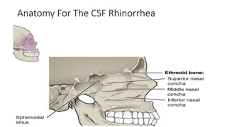 CSF Rhinorrhea | PPTX