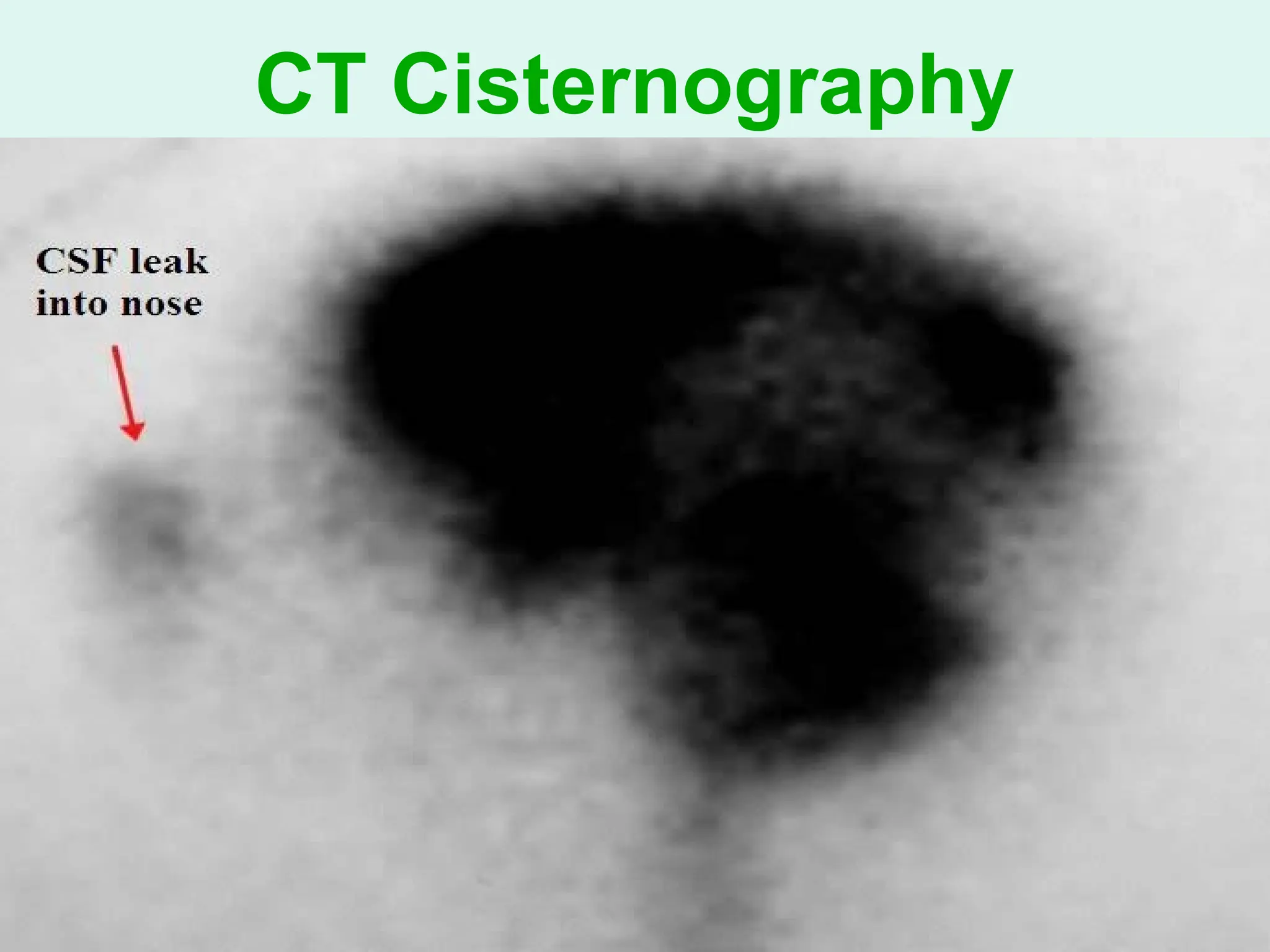 CSF rhinorrhea, choanal atresia, Septal hematoma, abscess .pptx