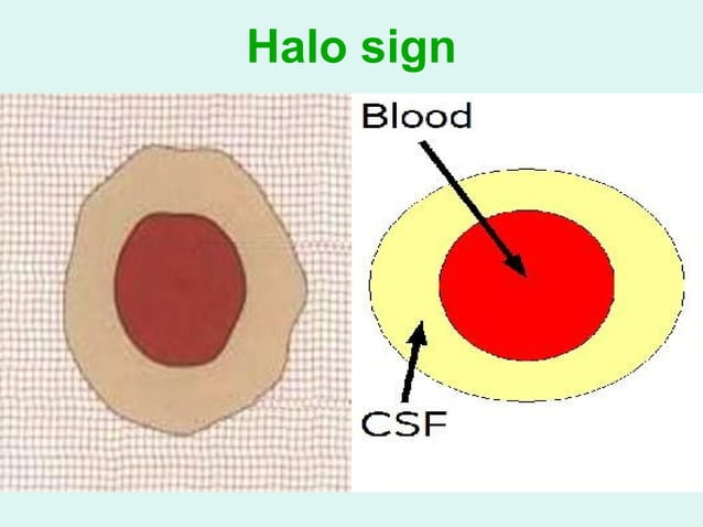CSF rhinorrhea, choanal atresia, Septal hematoma, abscess .pptx
