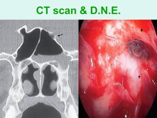 CSF rhinorrhea, choanal atresia, Septal hematoma, abscess .pptx