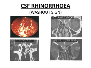 CSF Rhinorrhoea-Pakistan- Lahore | PPT