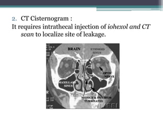 Csf rhinorrhoea | PPTX